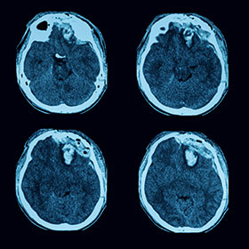 Surgical Treatment of Traumatic Brain and Spine Injuries in Boise, ID ...