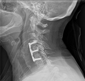 Boise Anterior Cervical Discectomy and Fusion (ACDF) Surgeon