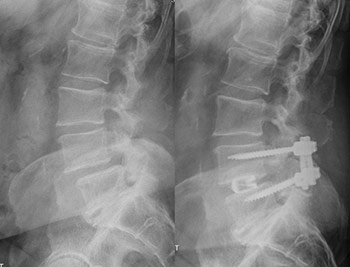 Boise Spine Surgeon | Spinal Surgery | Kelly Bridges Neurosurgery