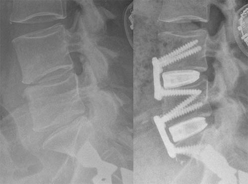 FAQ - Spinal Surgery General Questions and Answers