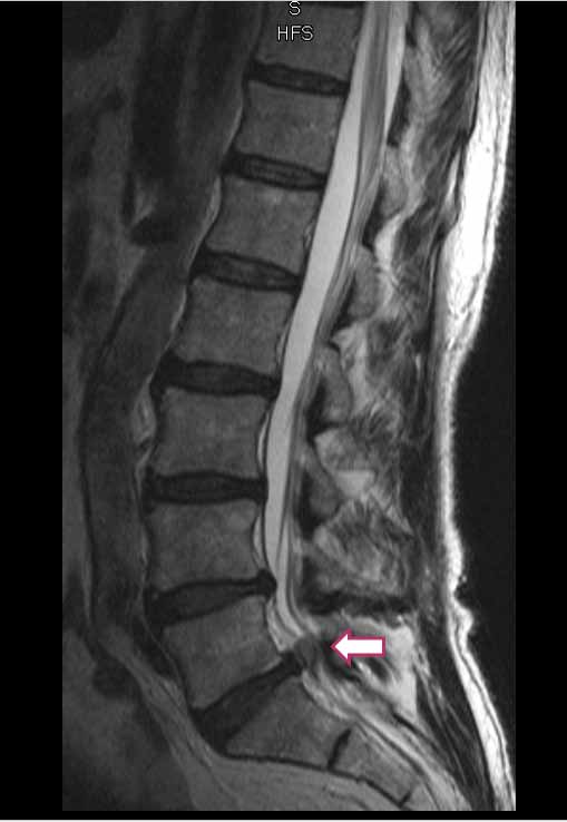 How Much Does a Herniated Disc Surgery Cost? - FAQs - Kelly Bridges ...